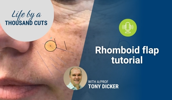 Rhomboid flap tutorial